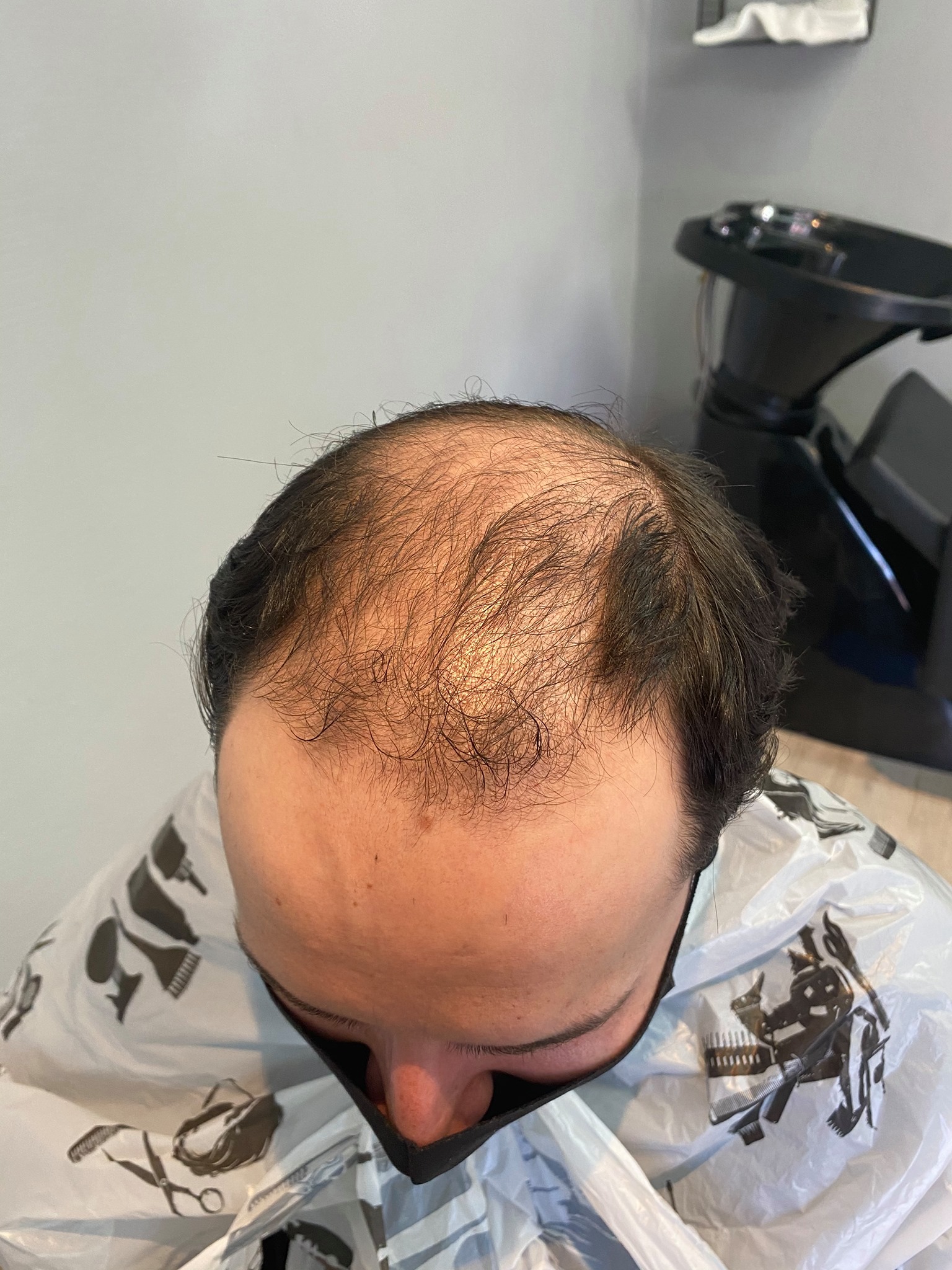 Men's Hair Replacement Bramhall | Hair Rejuvenation UK