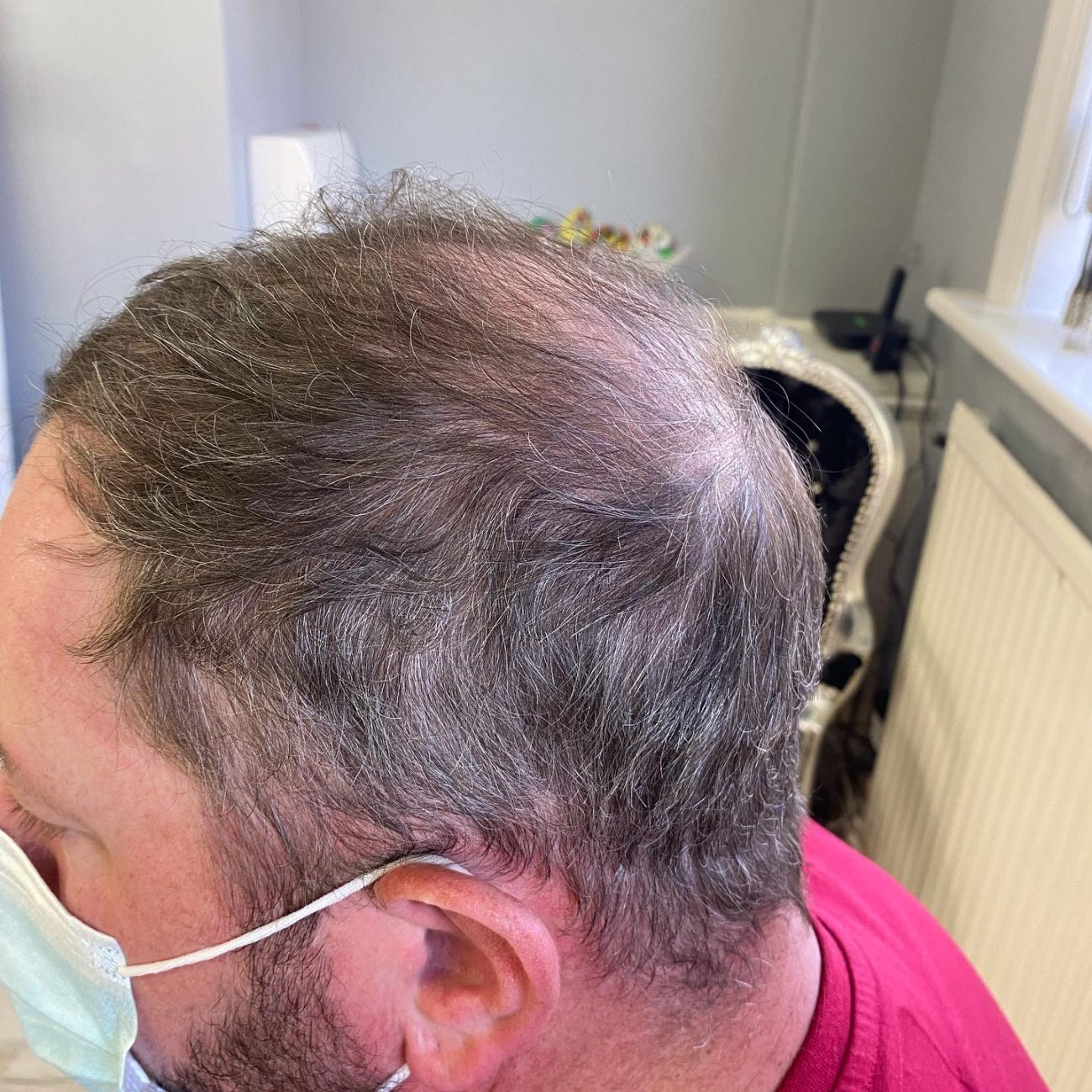 Men's Hair Replacement Bramhall | Hair Rejuvenation UK